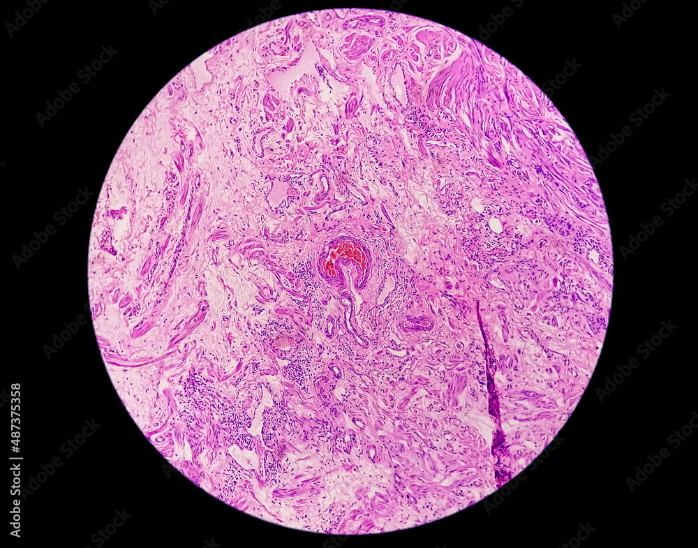 Ovarian cyst, Serous cyst adenofibroma, relatively rare benign ovarian ...