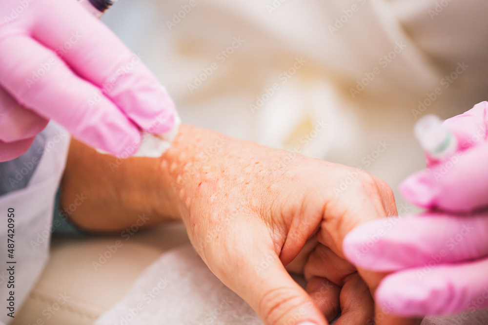 The doctor makes an injection of Botox filler into the arm of the ...