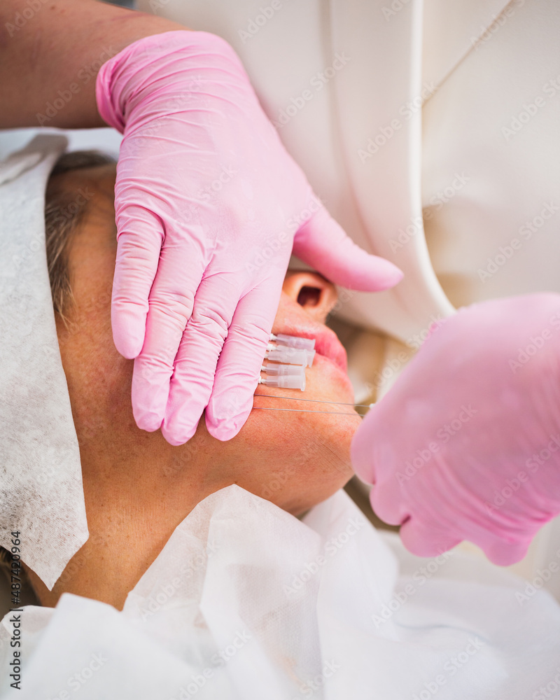 Thread lifting is a minimally invasive procedure for tightening the ...