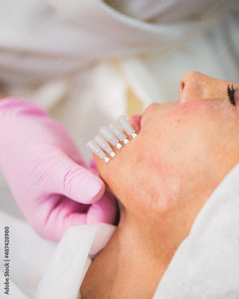 Thread lifting is a minimally invasive procedure for tightening the ...