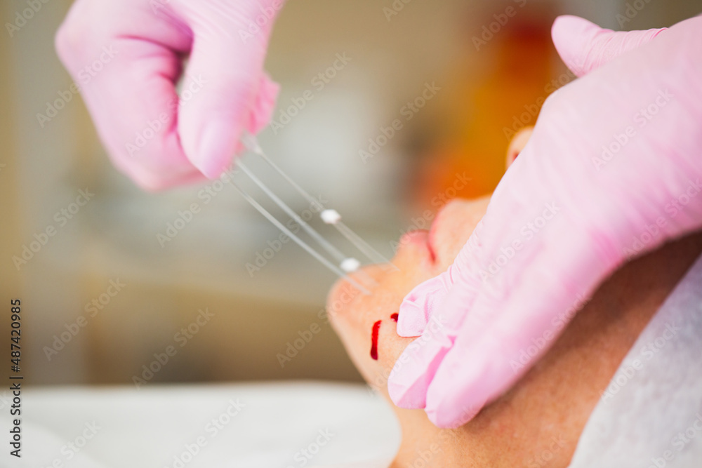 Thread lifting is a minimally invasive procedure for tightening the ...