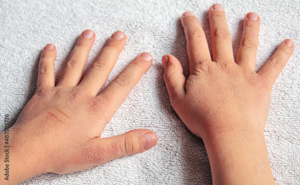 Red spots on the skin of the child's hands.children's allergy.selective ...
