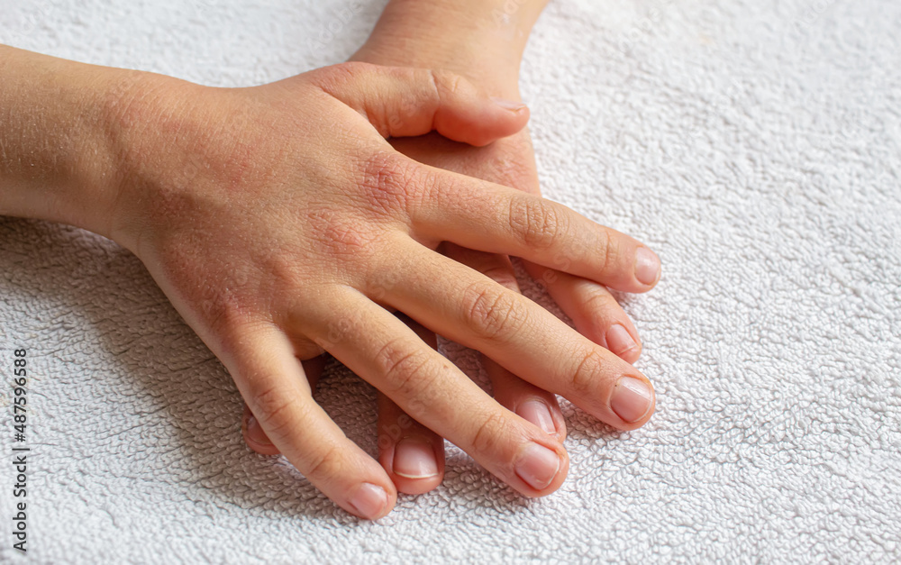 Red spots on the skin of the child's hands.children's allergy.selective ...