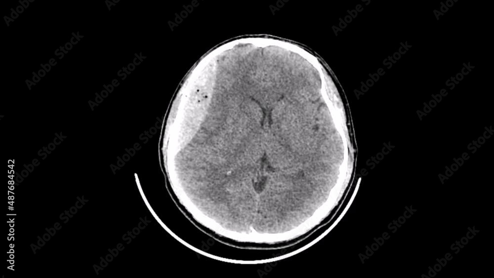 axial head ct scan image of right-sided epidural hemorrhage vídeo do ...