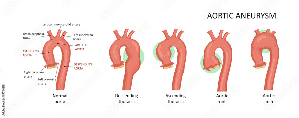 Types of aortic aneurysms: root, ascending, descending,arch. Stock ...