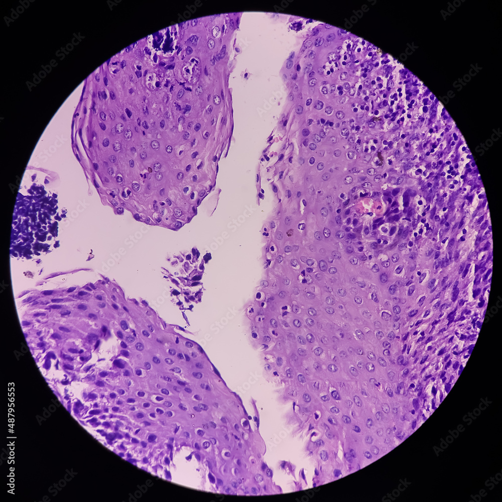 Chronic tonsillitis: Microscopic image of tonsillar tissue, show ...