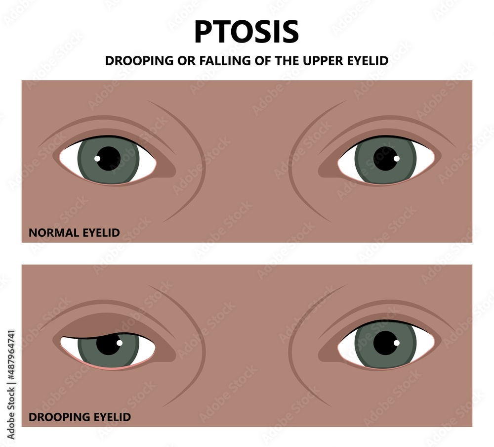 Ptosis eyelid lag Horner syndrome third nerve palsy retraction droopy ...