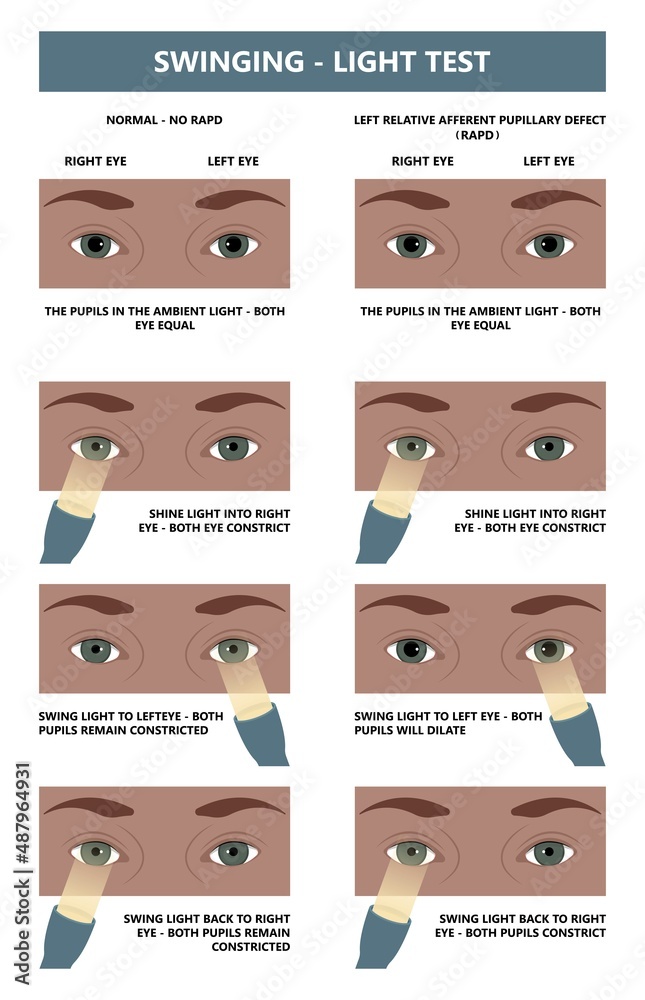Stockvector miosis eye pupil size iris retina brain Horner miotic ...