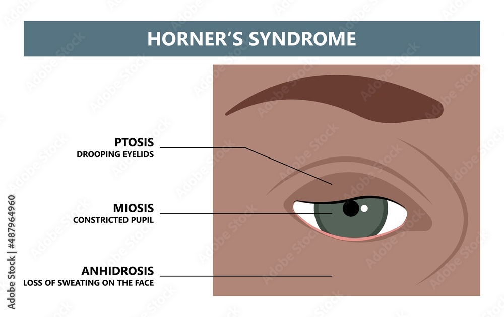 miosis eye pupil size iris retina brain Horner miotic muscle dilated ...