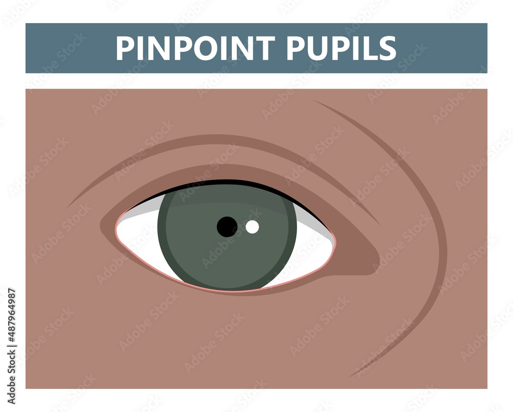 Vettoriale Stock miosis eye pupil size iris retina brain Horner miotic ...
