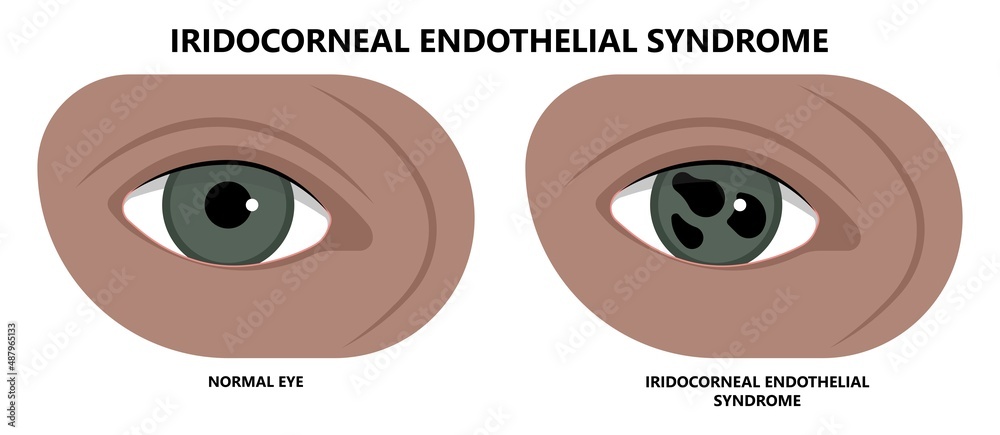 miosis eye pupil size iris retina brain Horner miotic muscle dilated ...