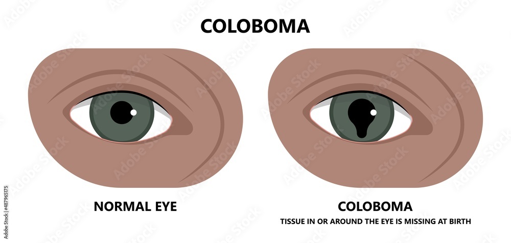 miosis eye pupil size iris retina brain Horner miotic muscle dilated ...