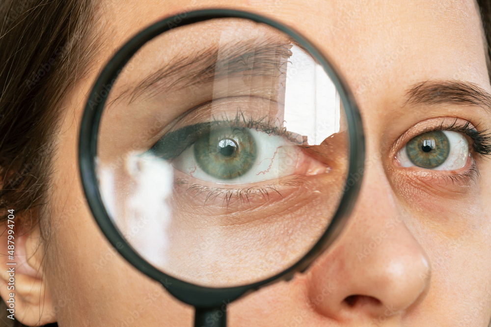 Close-up of woman's eye with red inflamed and dilated capillaries ...