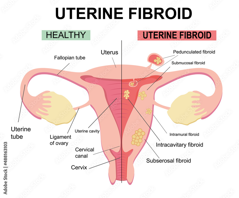 Types Of Uterine Fibroids Disease Of The Female Reproductive System