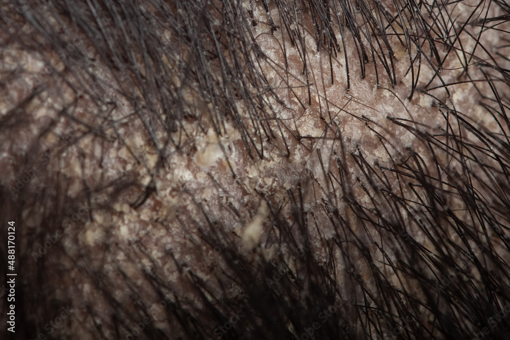 macro view of hair root or scalp with dandruff, seborrheic dermatitis ...