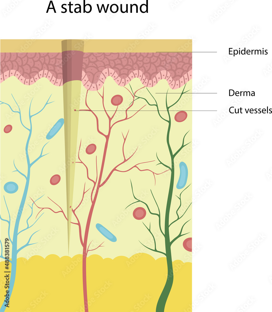 Vector illustration of the structure of a stab wound. Cut vessels. Skin ...