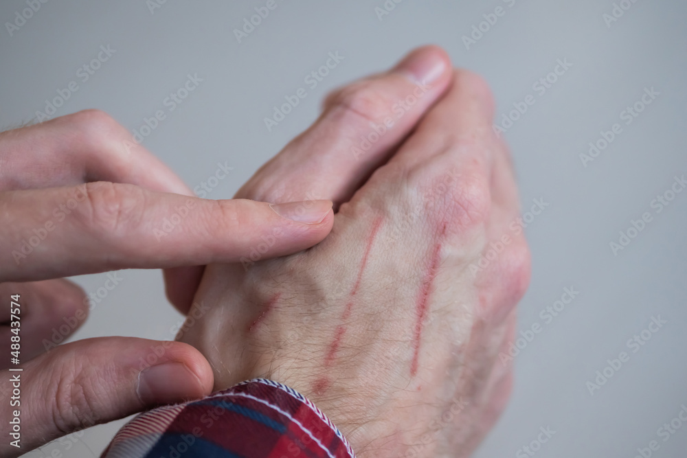 Close up - man showing hand with cat scratches on skin. Pain, damaged ...