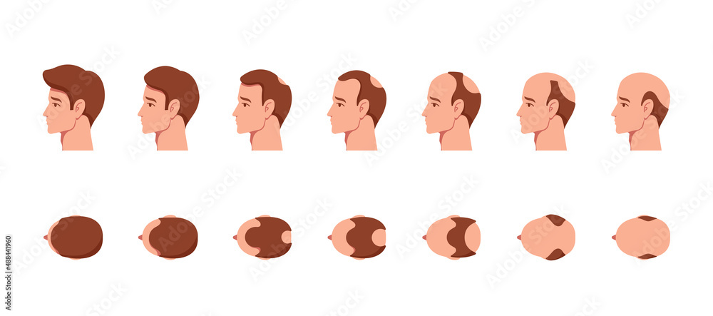 Stages of Baldness of Men. Male Characters Head Top and Side View with ...