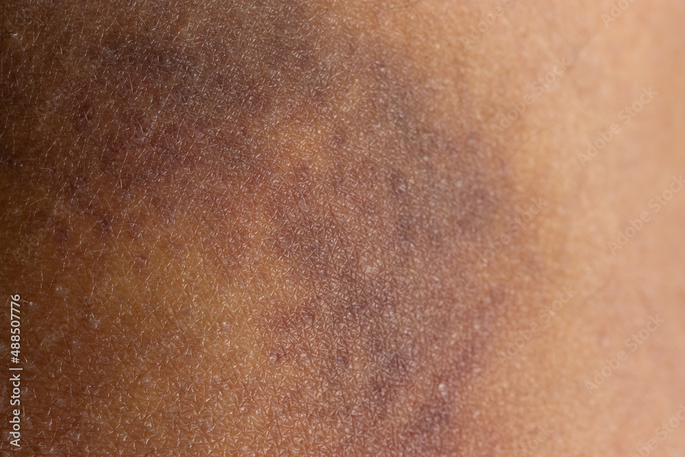 bruise on the skin of the leg as a background Stock Photo | Adobe Stock