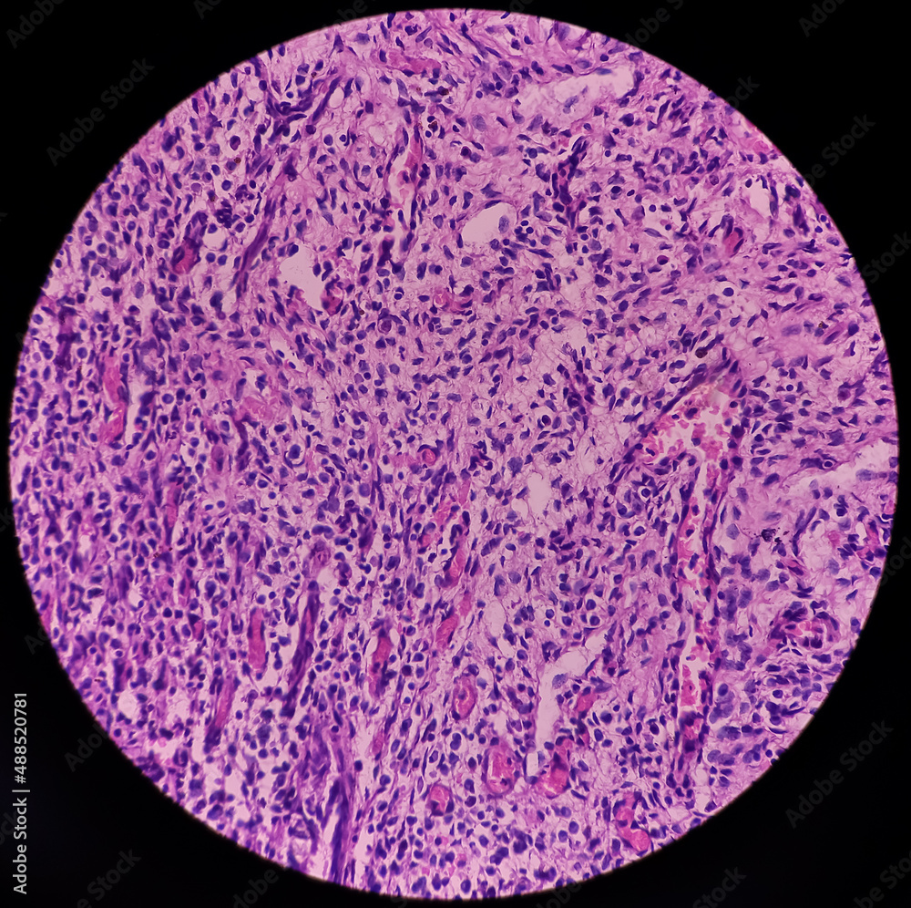 Urinary bladder(biopsy): Chronic cystitis, microscopic show bladder ...