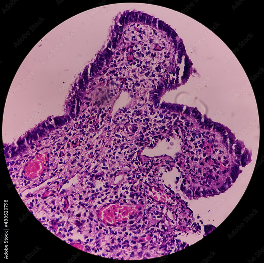 Urinary bladder(biopsy): Chronic cystitis, microscopic show bladder ...