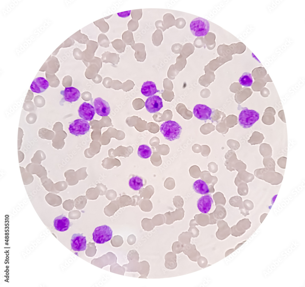 1000x, abnormal, acute, all, aml, analyzing, apl, blast, blood, bone ...