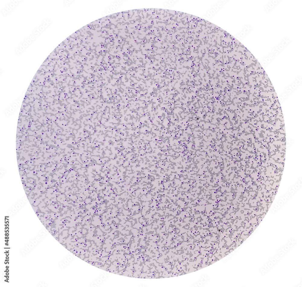 1000x, abnormal, acute, all, aml, analyzing, apl, blast, blood, bone ...