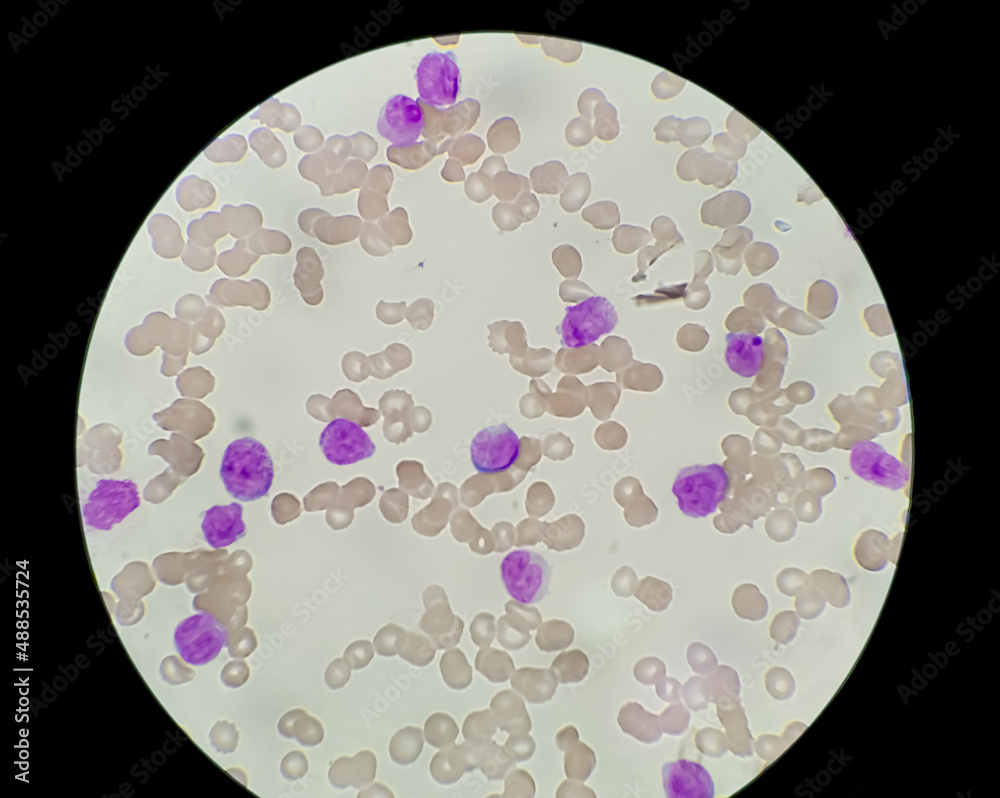 1000x, abnormal, acute, all, aml, analyzing, apl, blast, blood, bone ...