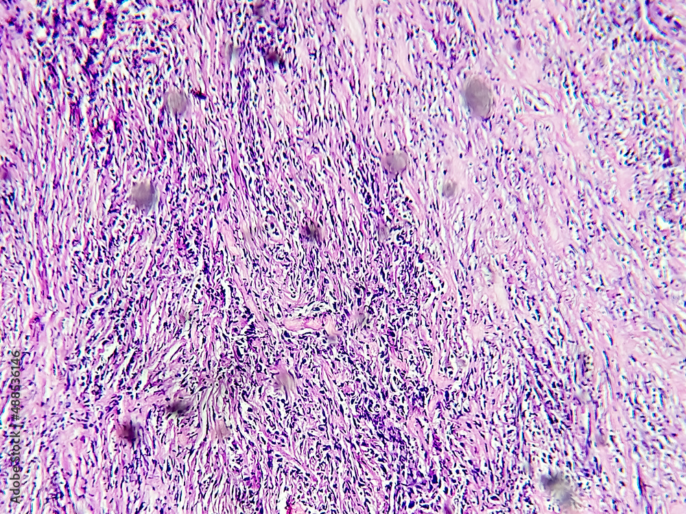 Tissue form Gallbladder (Laparoscopic cholecysectomy) hematoxylin and ...