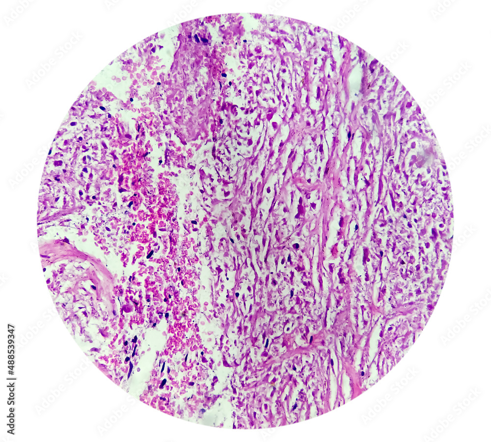 Tissue form Gallbladder (Laparoscopic cholecysectomy) hematoxylin and ...