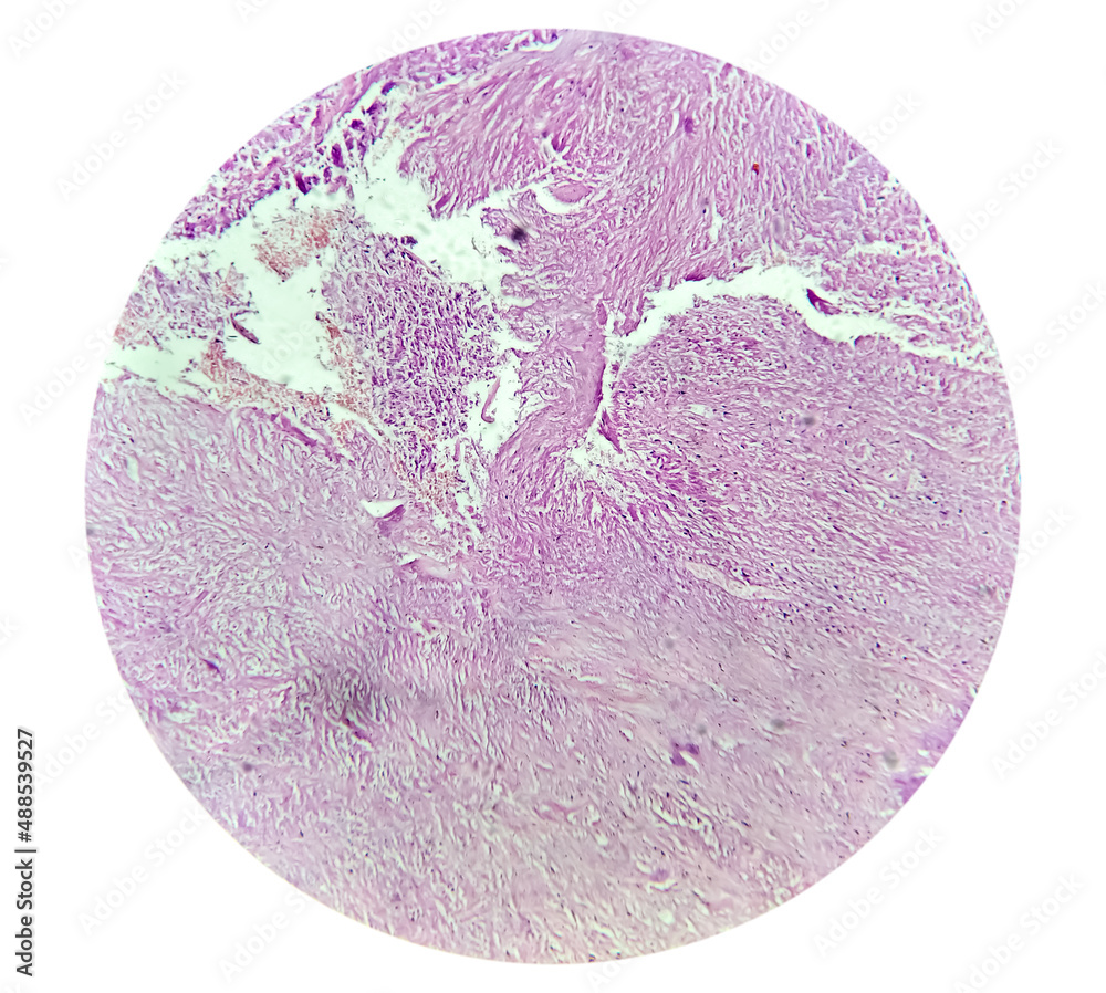 Tissue form Gallbladder (Laparoscopic cholecysectomy) hematoxylin and ...