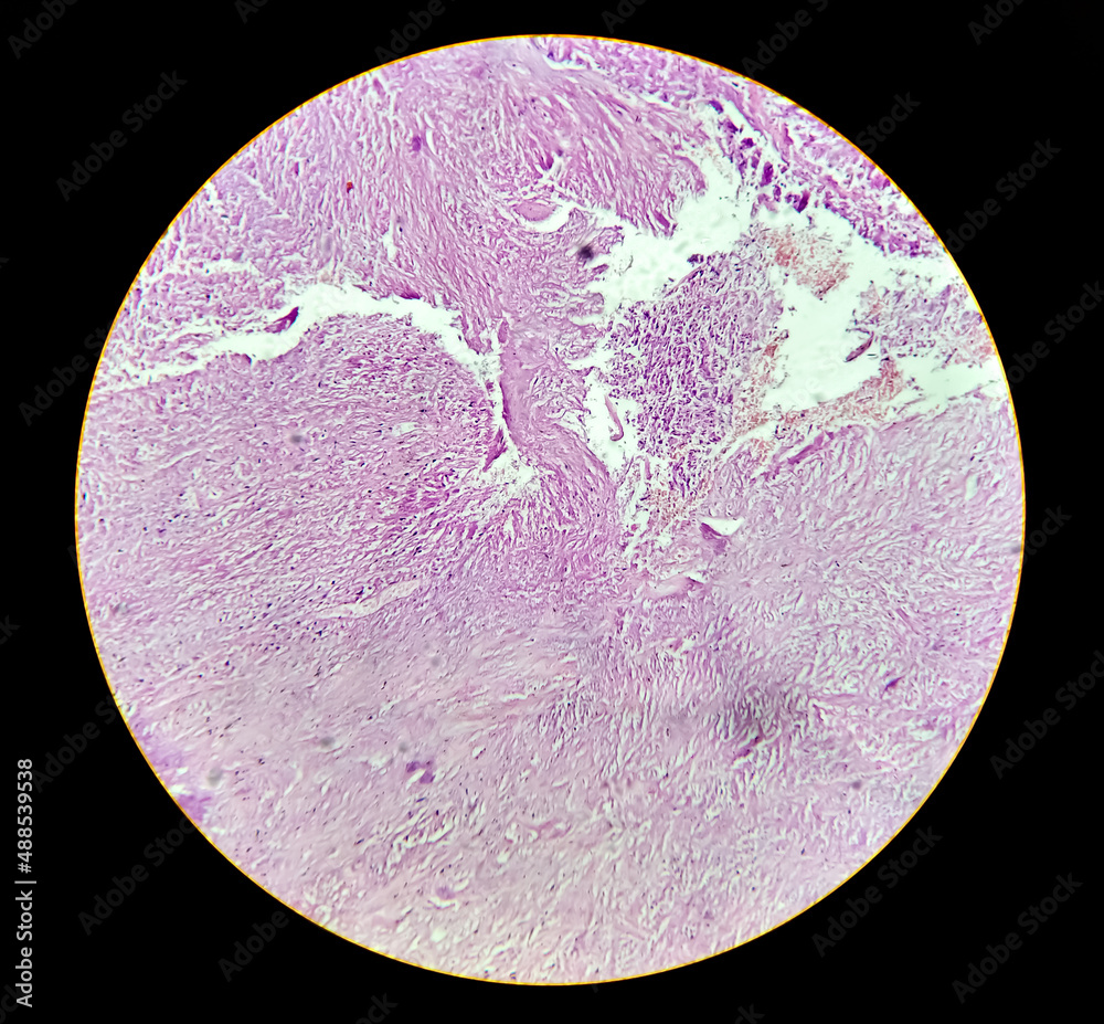 Tissue form Gallbladder (Laparoscopic cholecysectomy) hematoxylin and ...