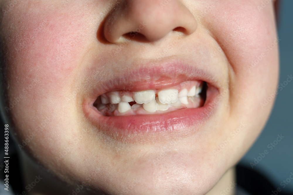 Seven year boy showing his primary and growing permanent teeth. Stock ...