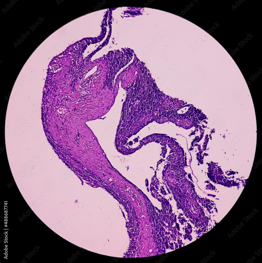 Scapula cancer: Synovial sarcoma, monophasic, show malignant neoplasm ...