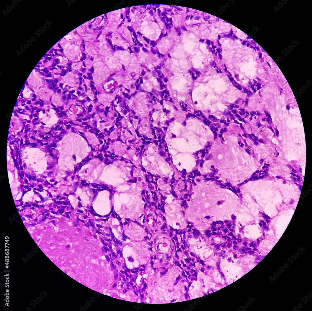 Fototapeta kuchenna Scapula cancer: Synovial sarcoma, monophasic, show ...