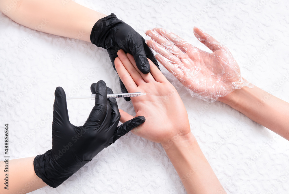 Palm hyperhidrosis treatment. Injection of a preparation containing ...