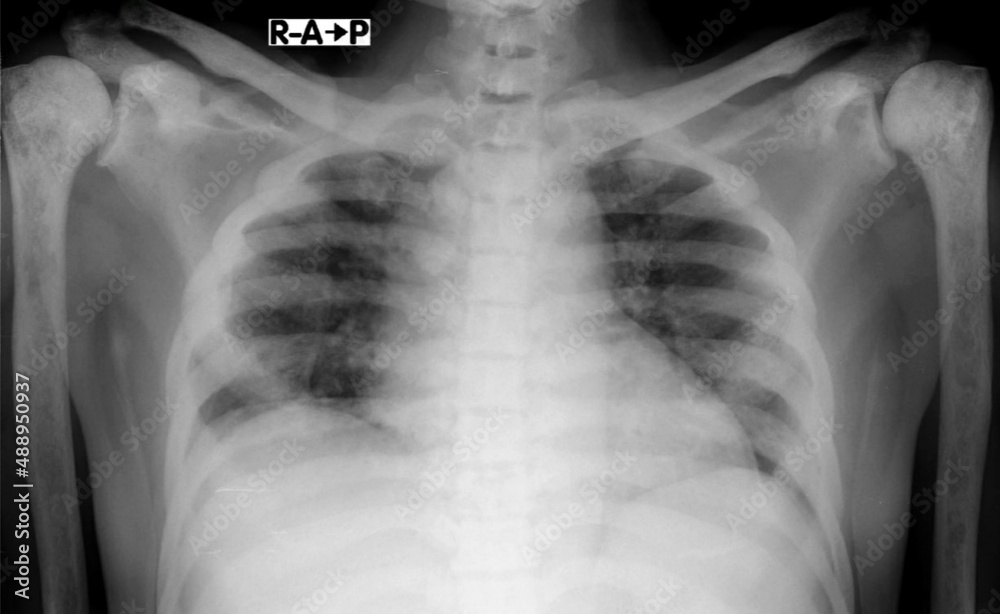 x ray of a bone metastasis proses ,osteoblastic lesionon chest bones ...
