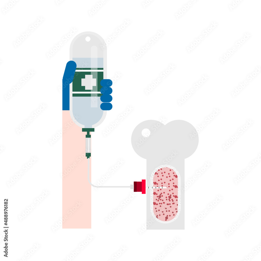 Intraosseous access procedure, needle through cortical bone and into ...