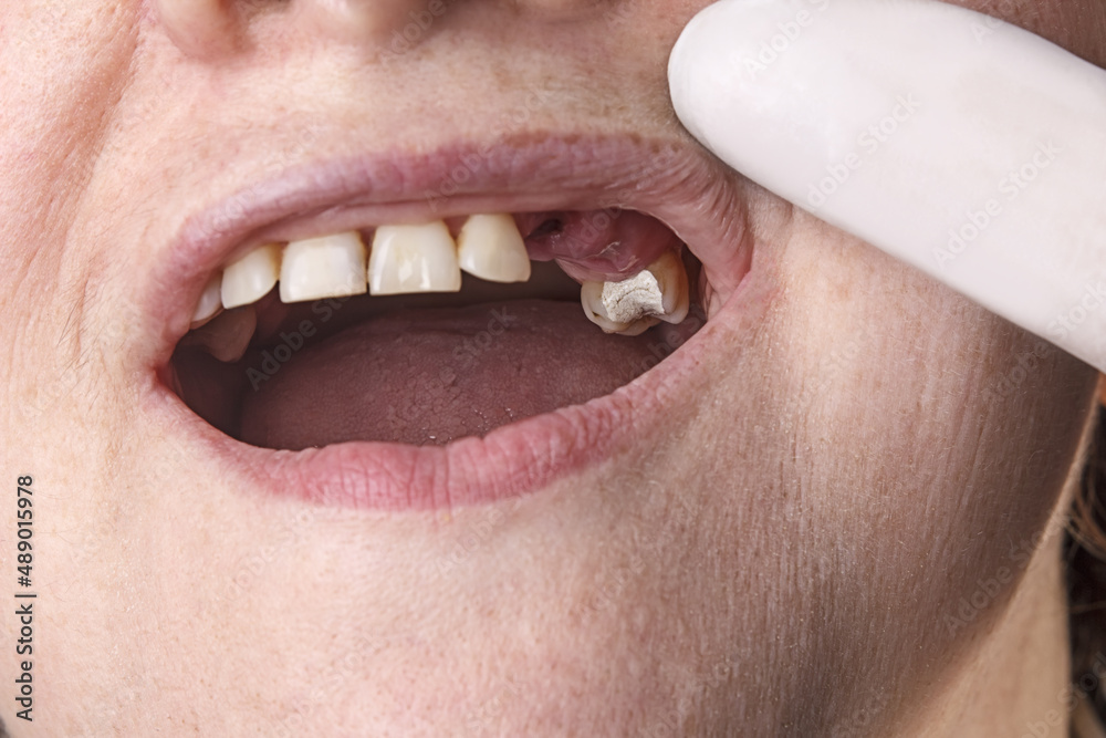 Examination of the oral cavity at the dentist. Temporary tooth filling ...