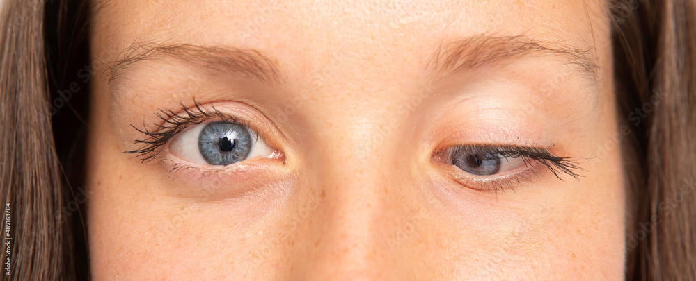 Poster Young woman with strabismus and floppy eyelid syndrome – Wall ...