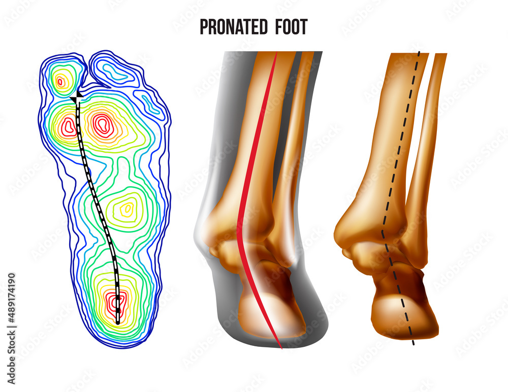 Pronated foot, arch deformation, bottom and back view . Foot weight ...