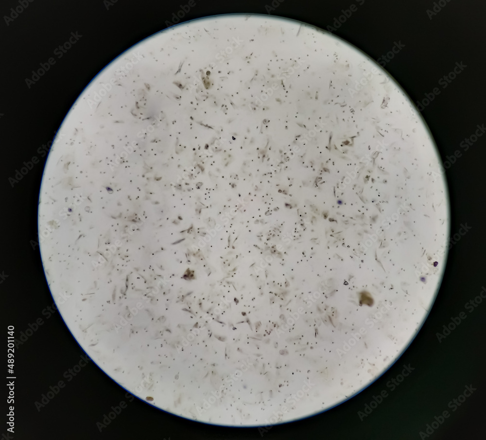 Microscopic image show Pus cells and Epithelial cells . Urinary tract ...