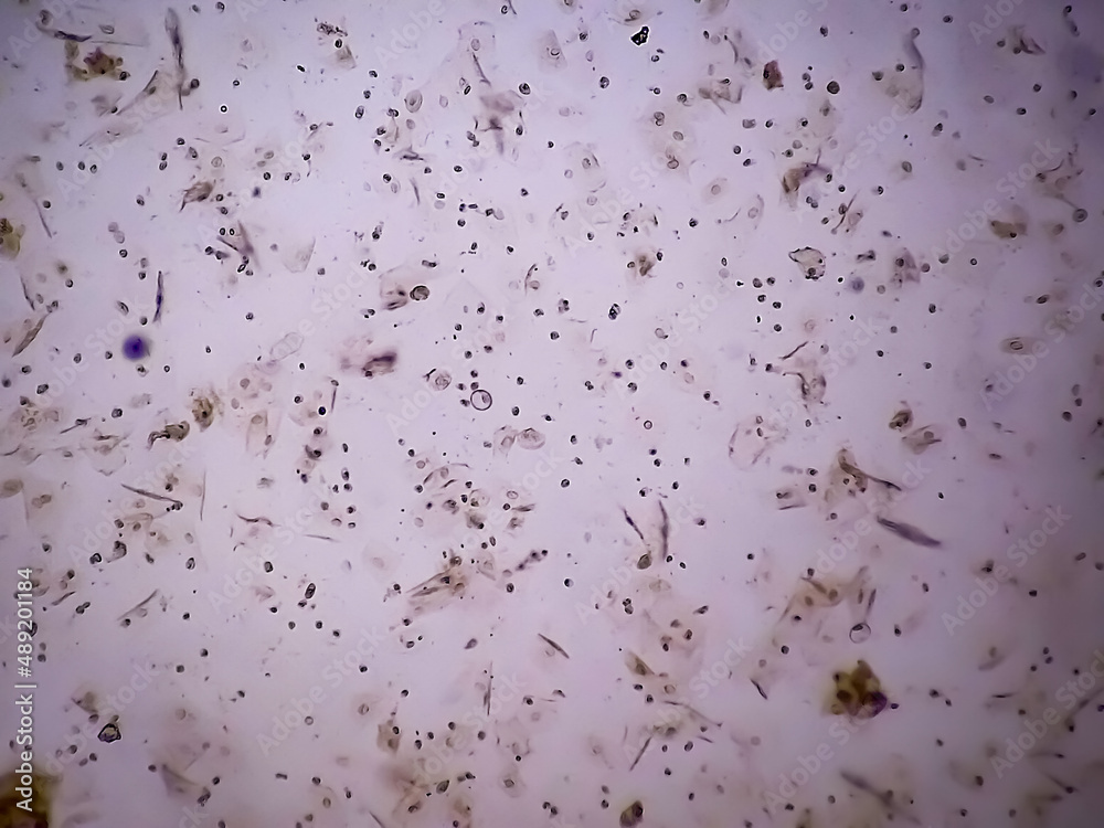 Microscopic image show Pus cells and Epithelial cells . Urinary tract ...