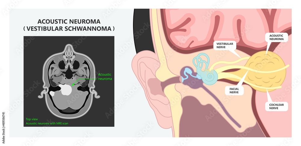 Acoustic neuroma tumor brain nerve inner ear loss cancer test MRI X-RAY ...