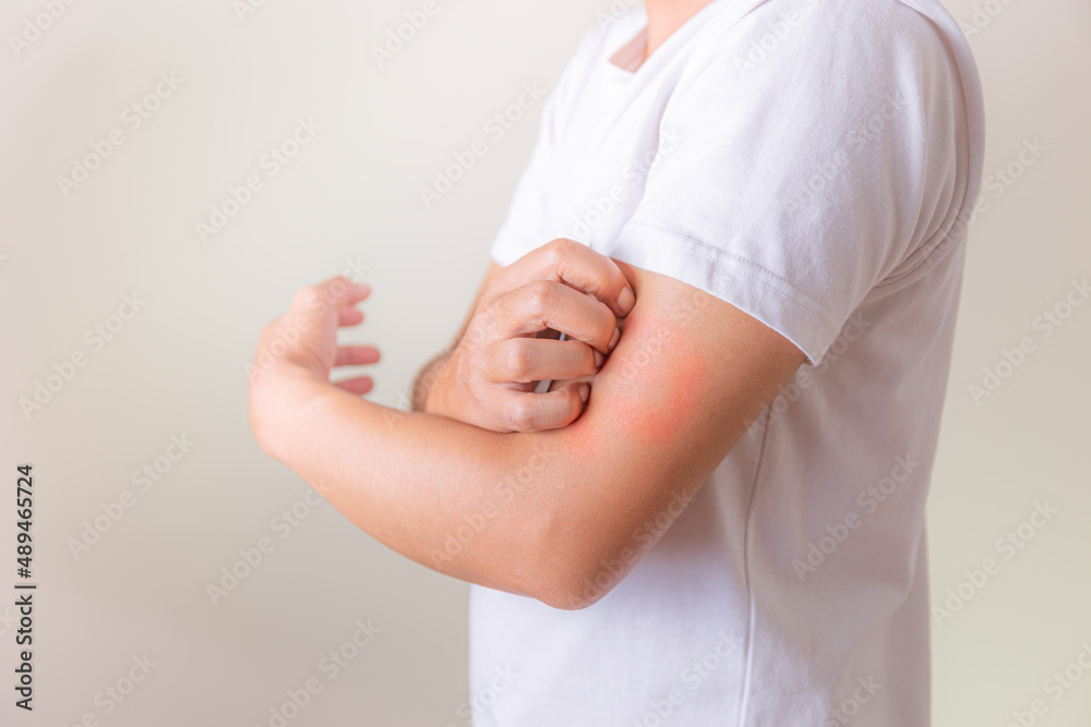 Man scratching itch with hands on the back of the hand / itching and ...