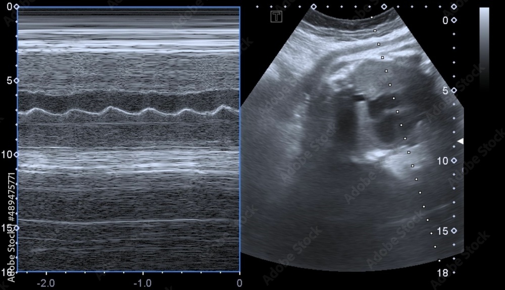 ultrasound of baby heartbeat Stock Photo | Adobe Stock