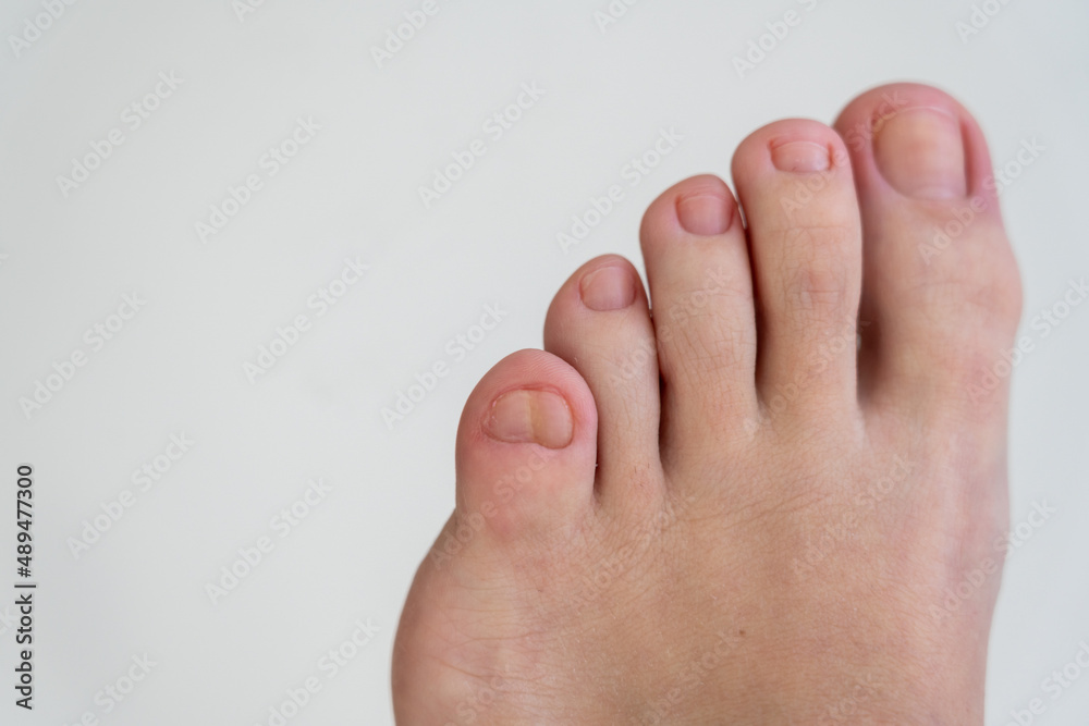 Female feet with a big double little toe on white background Stock ...