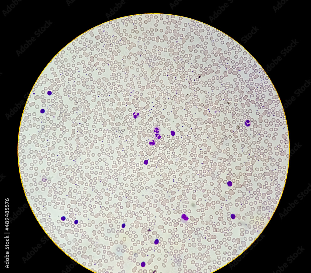 Foto de Neutrophil cell (white blood cell) in blood smear, analyze by ...