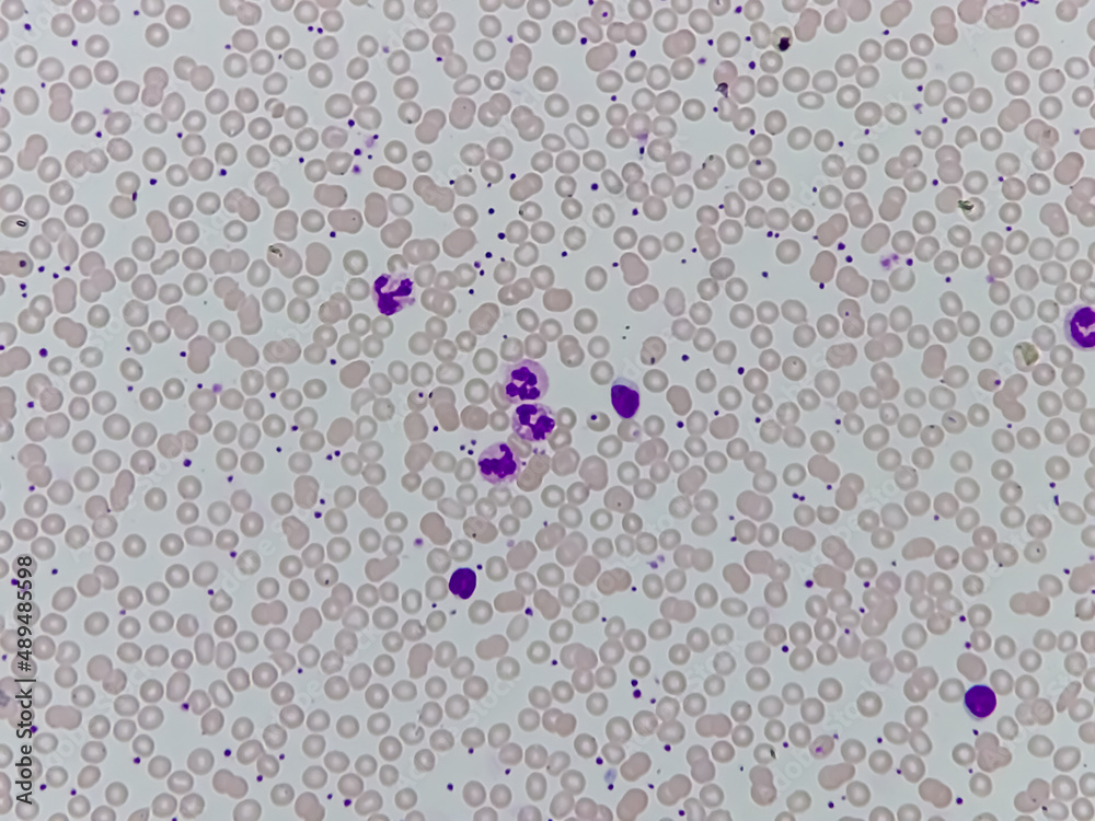 Neutrophil cell (white blood cell) in blood smear, analyze by ...
