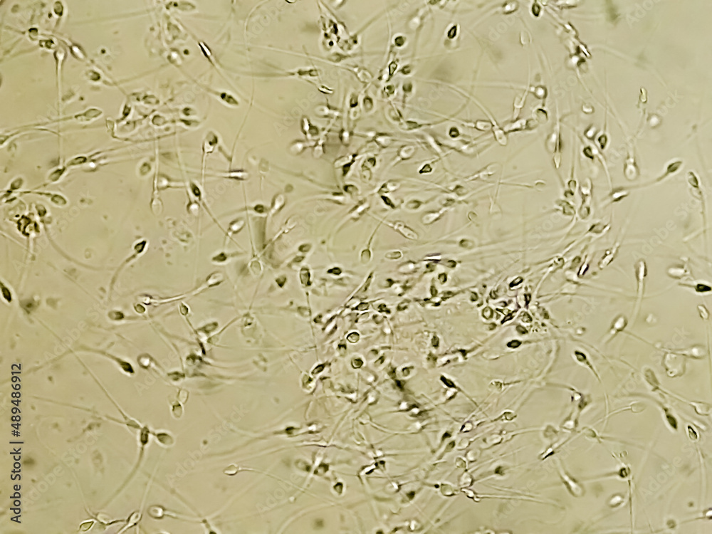 Polyzoospermia analyzed by microscope. Semen analysis normal sperm and ...